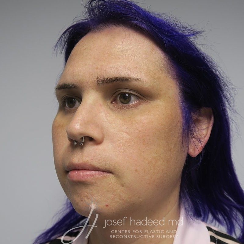 Facial Feminization #0717 | Josef Hadeed Plastic Surgery