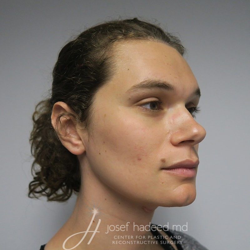 Facial Feminization #9885 | Josef Hadeed Plastic Surgery