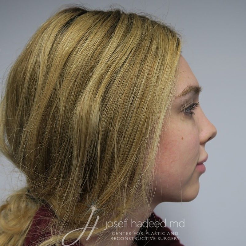 Facial Feminization #9169 | Josef Hadeed Plastic Surgery