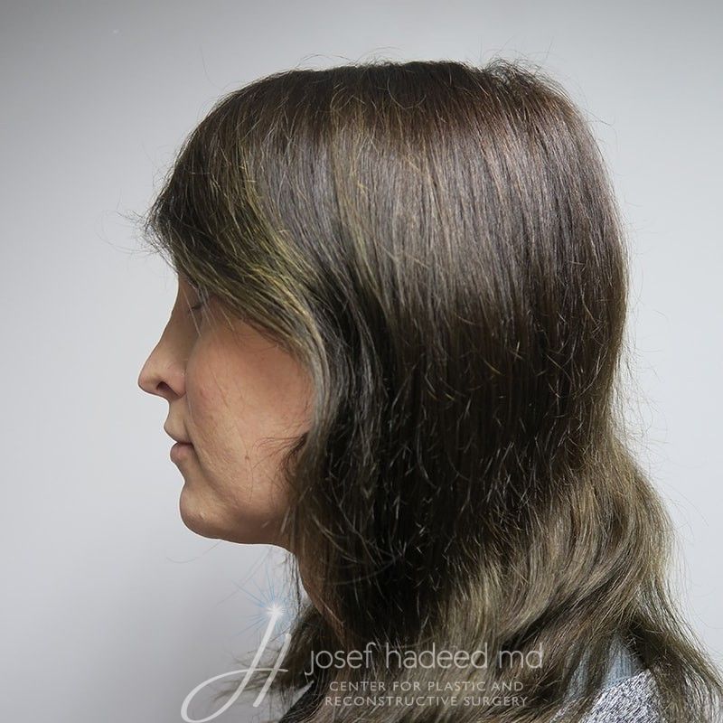 Facial Feminization #1809 | Josef Hadeed Plastic Surgery