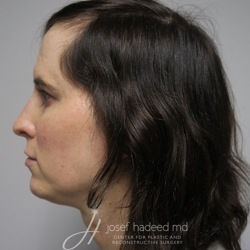 Facial Feminization #1809 | Josef Hadeed Plastic Surgery