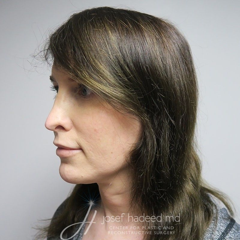 Facial Feminization #1809 | Josef Hadeed Plastic Surgery