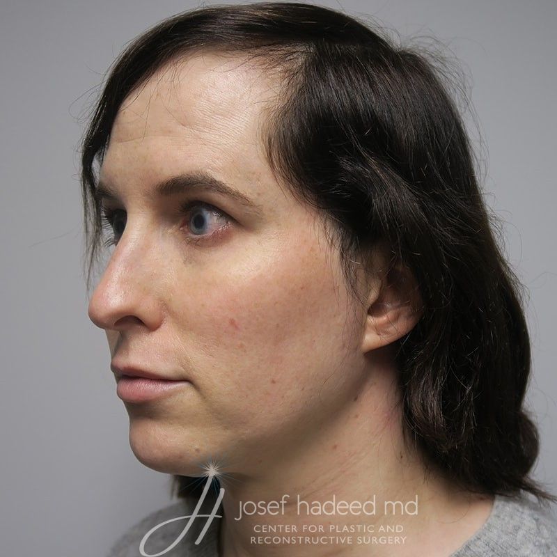 Facial Feminization #1809 | Josef Hadeed Plastic Surgery