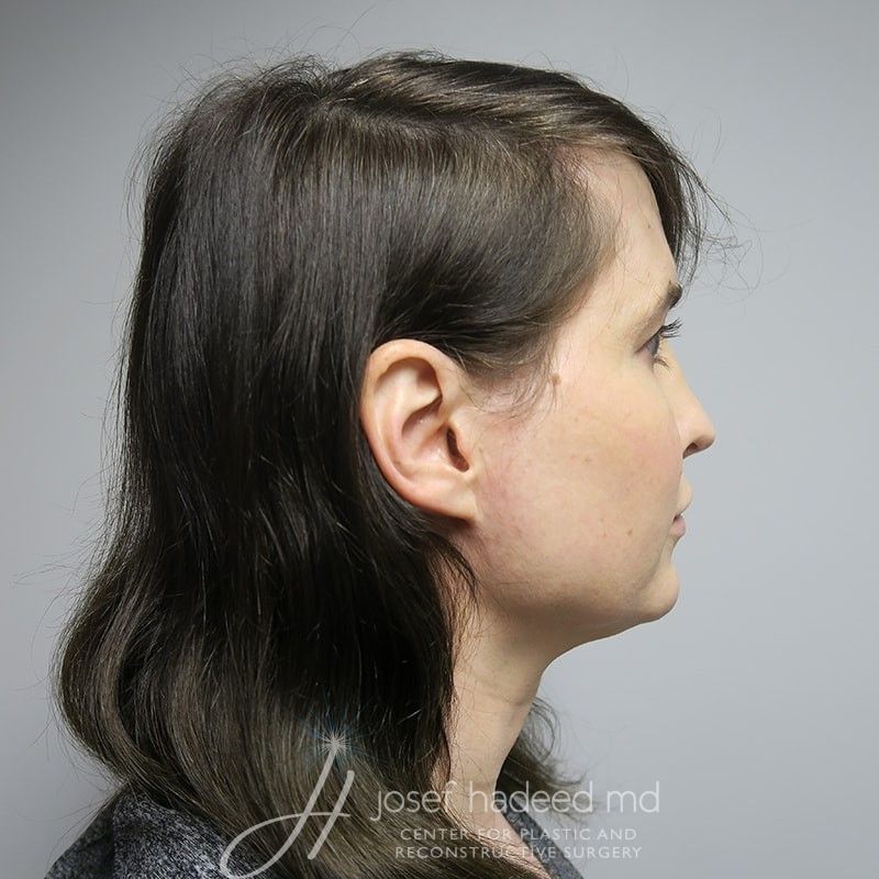 Facial Feminization #1809 | Josef Hadeed Plastic Surgery