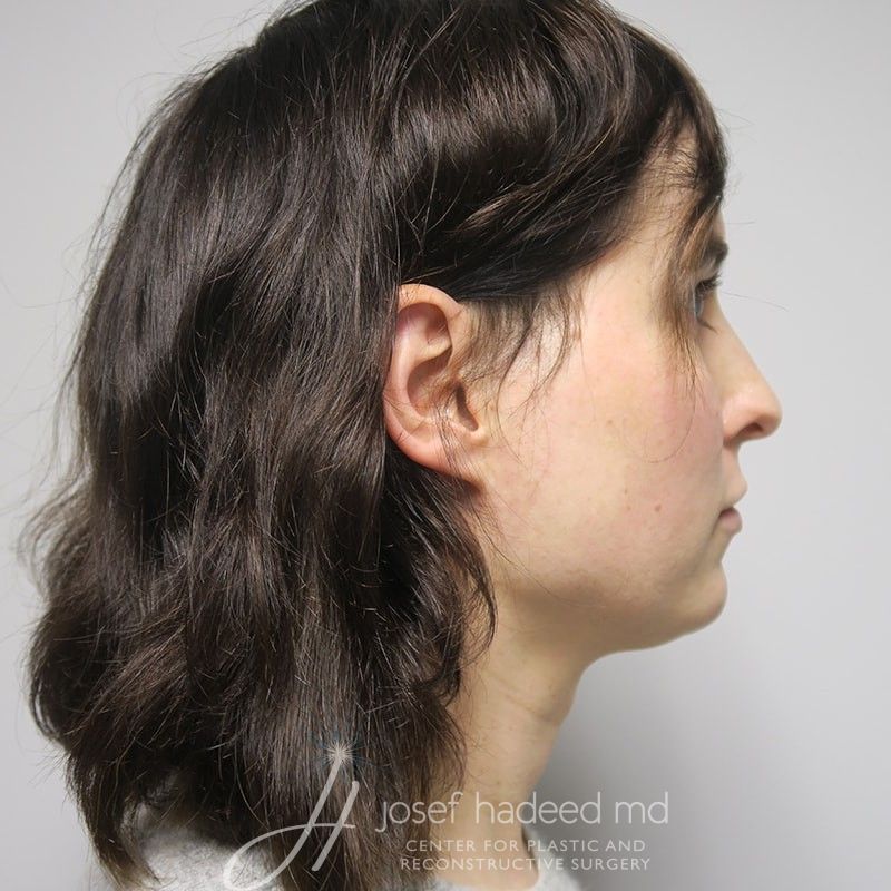 Facial Feminization #1809 | Josef Hadeed Plastic Surgery