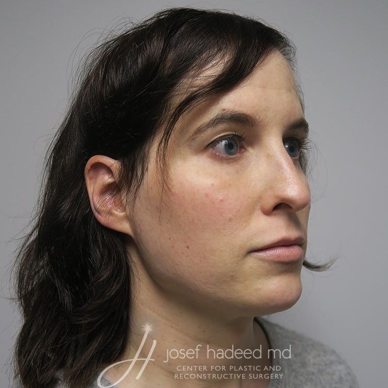 Facial Feminization #1809 | Josef Hadeed Plastic Surgery