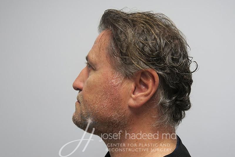 Hair Transplant #7057 | Josef Hadeed Plastic Surgery
