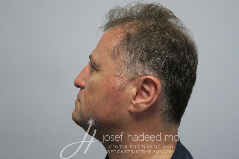 Hair Transplant #7057 | Josef Hadeed Plastic Surgery