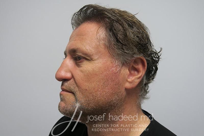 Hair Transplant #7057 | Josef Hadeed Plastic Surgery