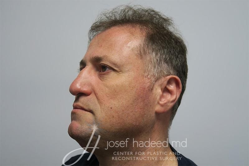 Hair Transplant #7057 | Josef Hadeed Plastic Surgery
