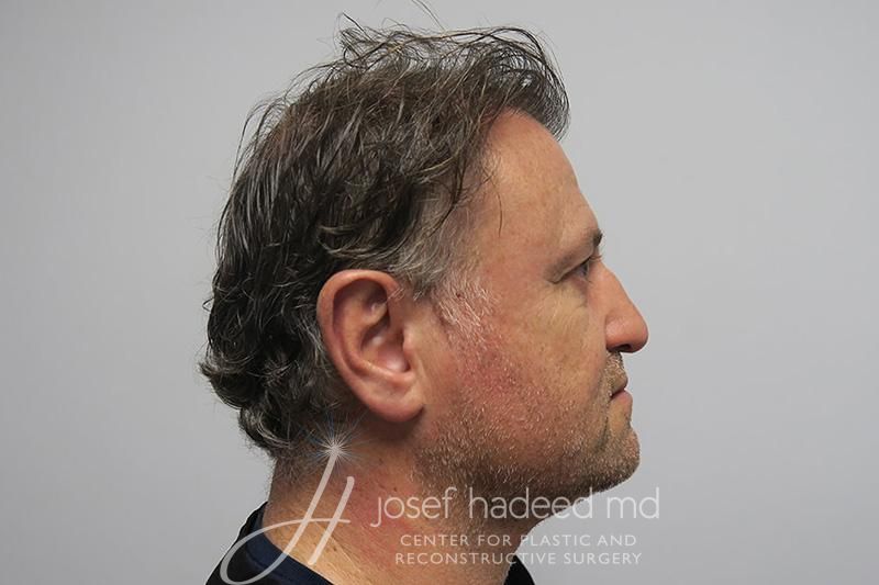 Hair Transplant #7057 | Josef Hadeed Plastic Surgery