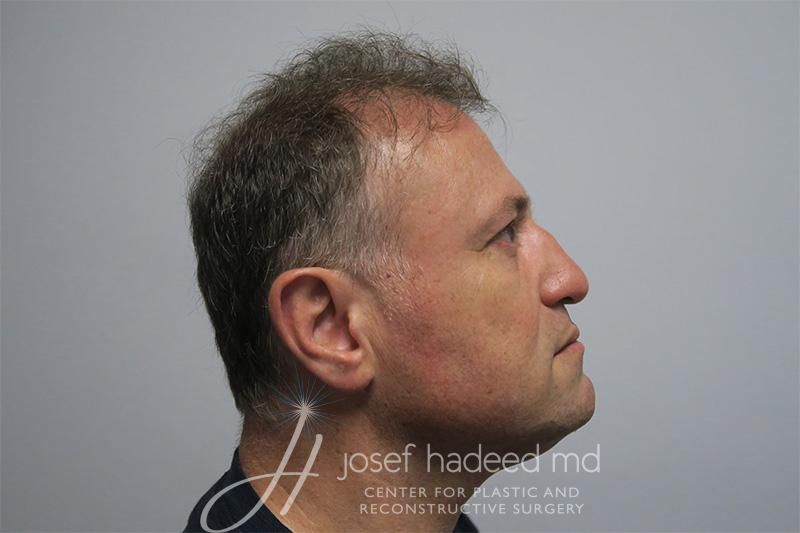 Hair Transplant #7057 | Josef Hadeed Plastic Surgery
